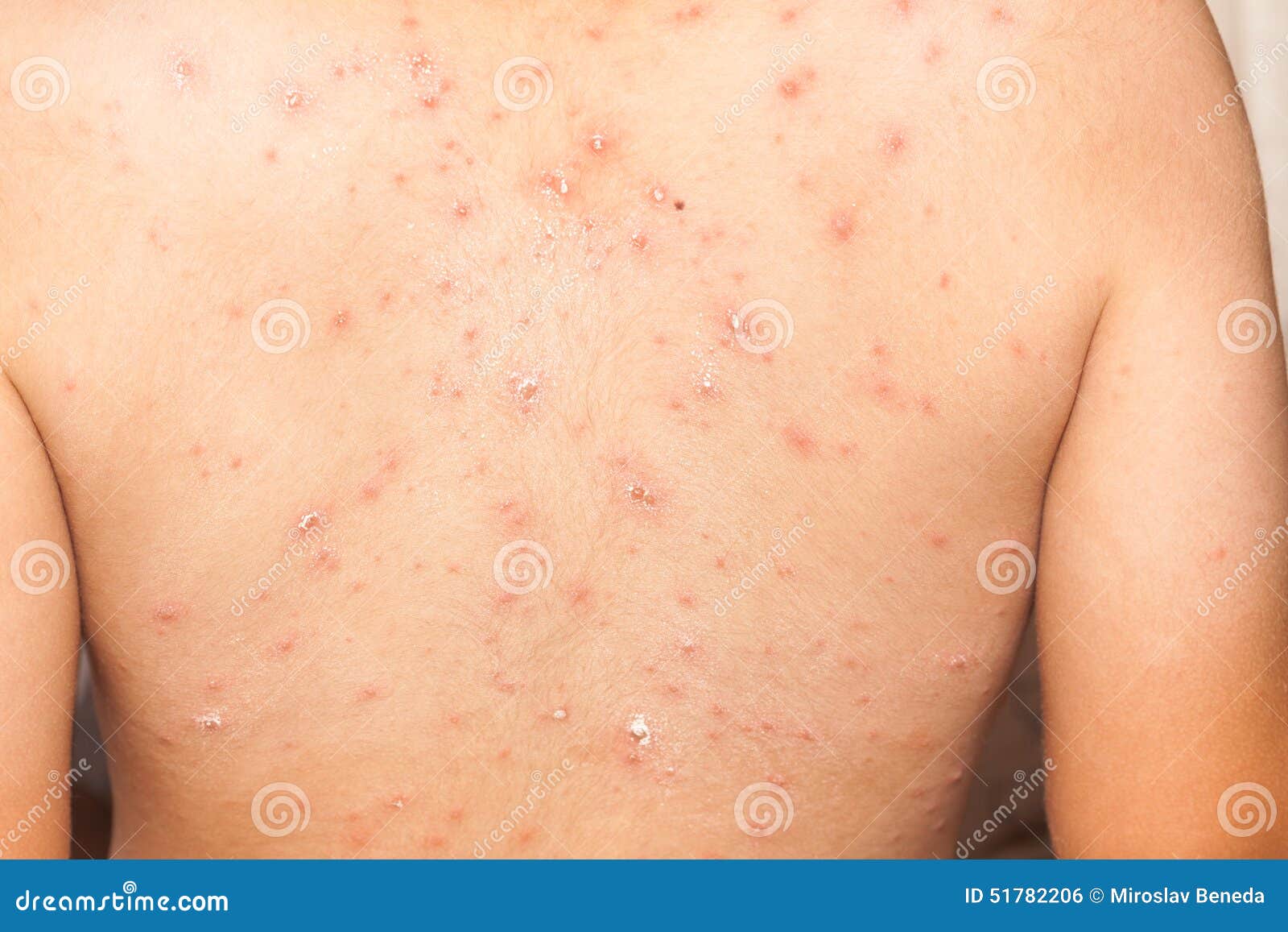 Pocken stockfoto. Bild von bakteriell, gesundheit, kränklich - 51782206