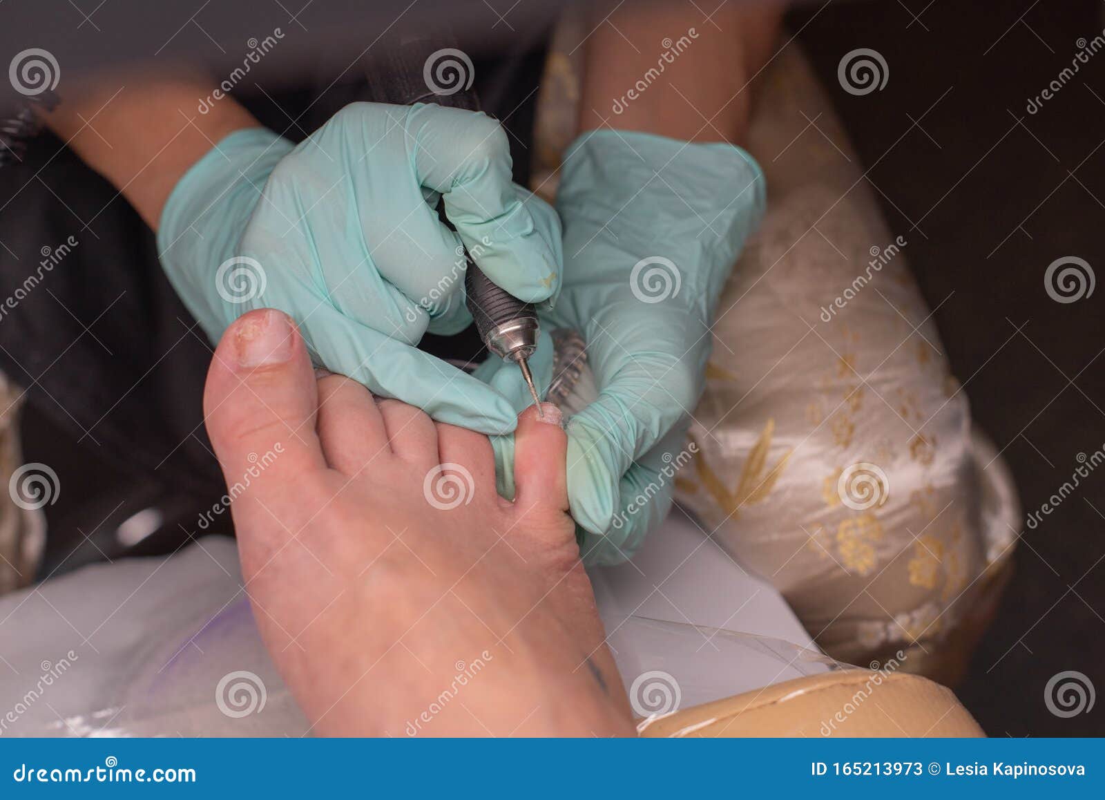 Podiatrist Treating Toenail Fungus Podology Treatment Podology