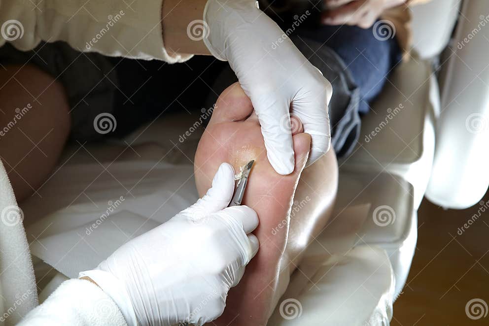 A Podiatrist Works with a Scalpel Stock Photo - Image of technique ...