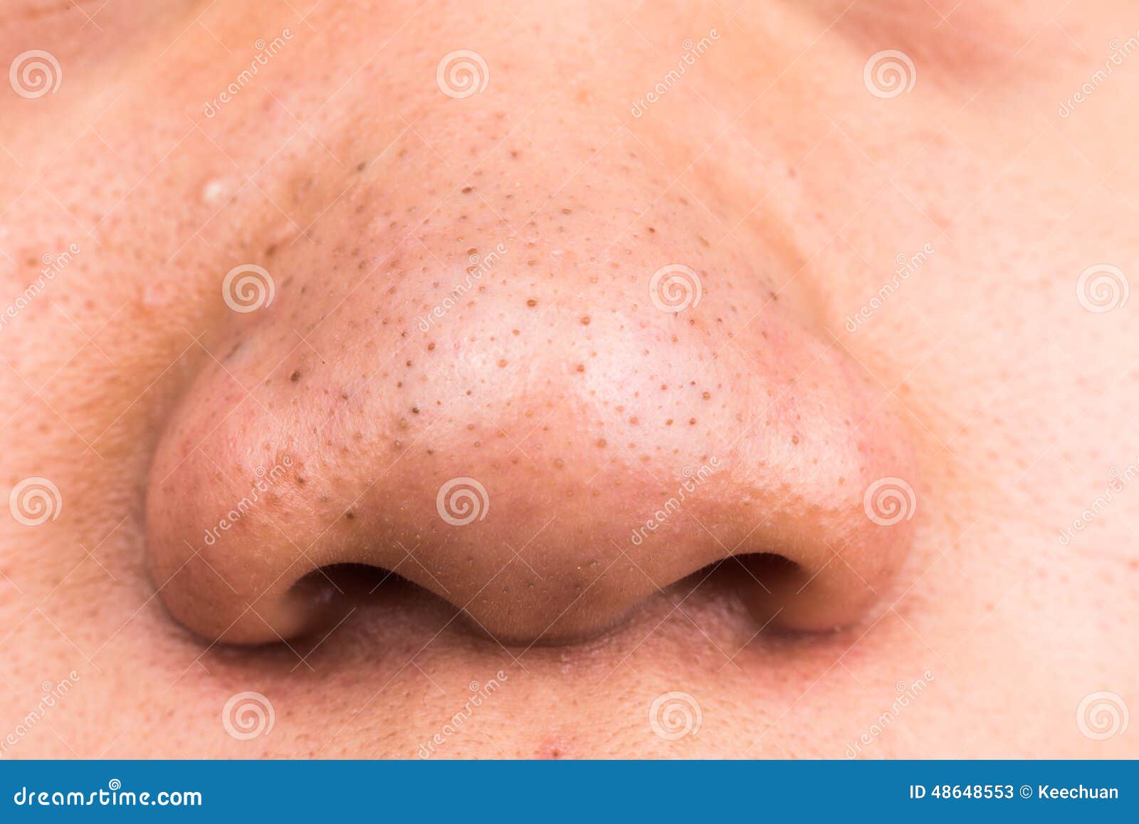 Points Noirs De Bouton Sur Le Nez Image stock - Image du défaut ...