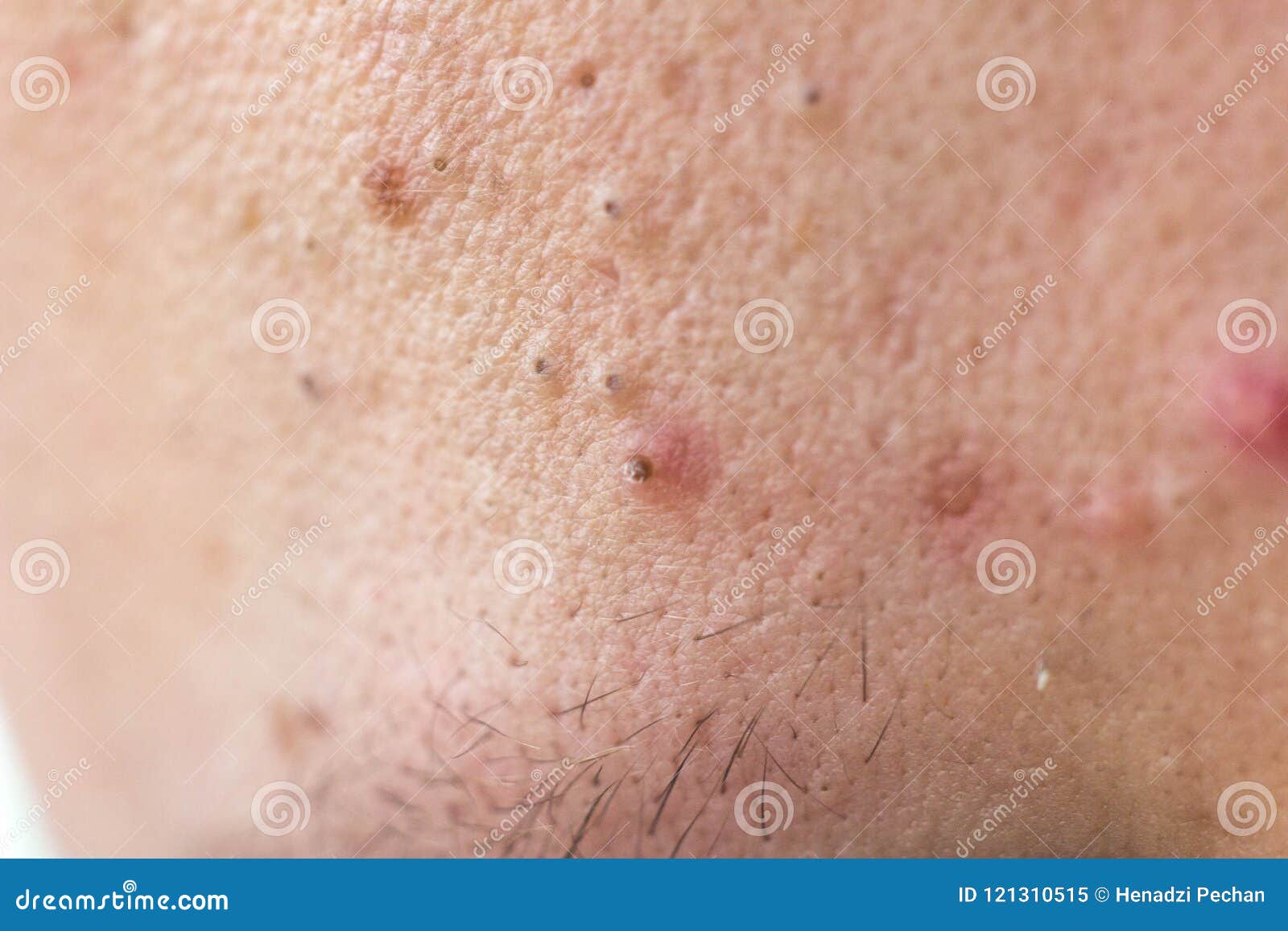 Points Noirs Sur Le Macro De Visage Et De Boutons, Point Noir Image ...