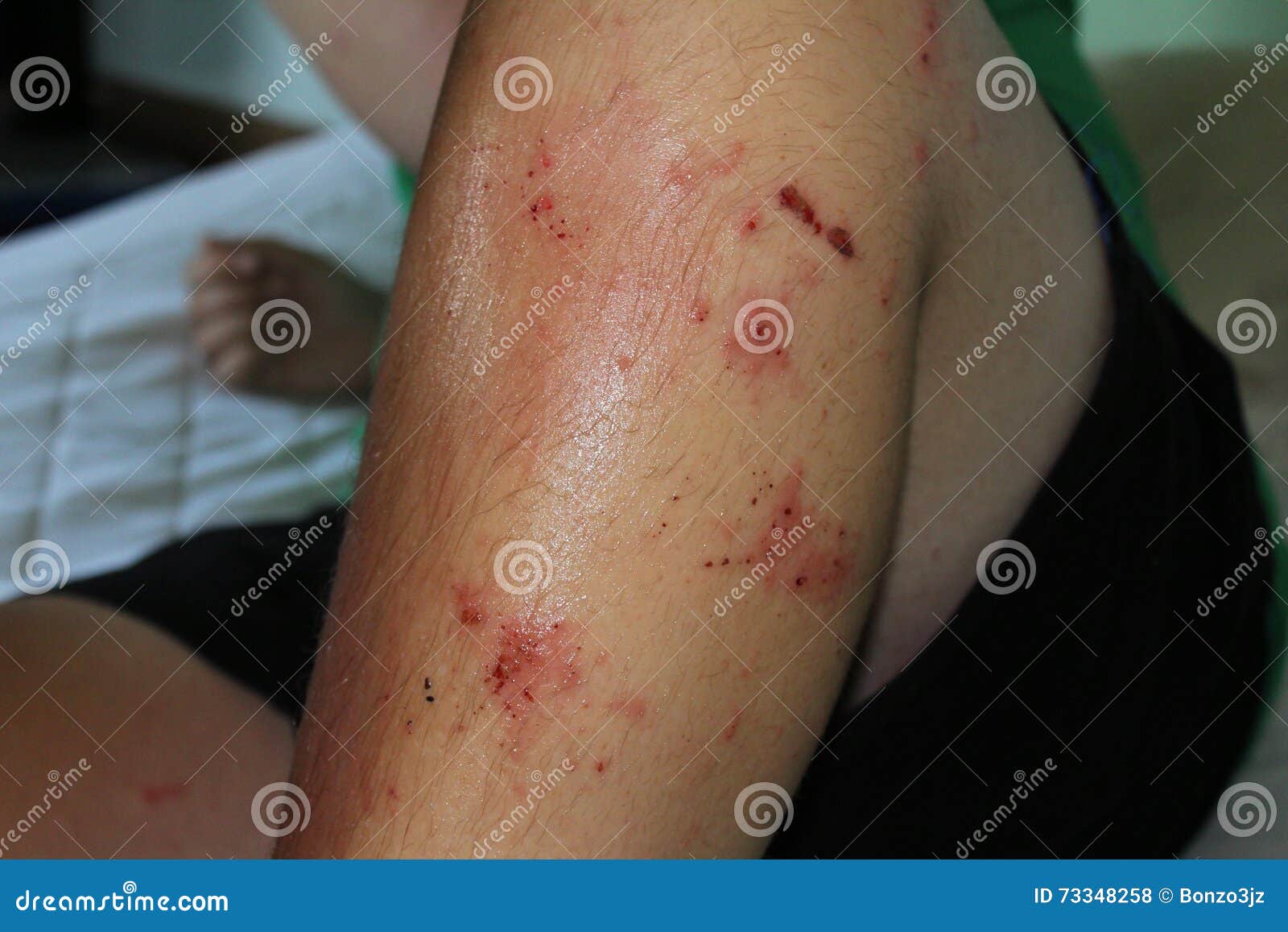 Poison Ivy Rash stock photo. Image of burn, tennessee - 73348258