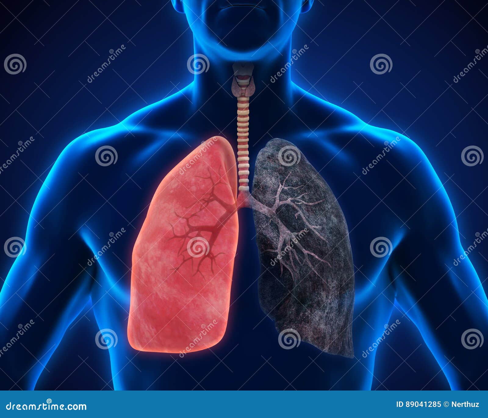 Polmone Sano E Polmone Dei Fumatori Illustrazione di Stock ...