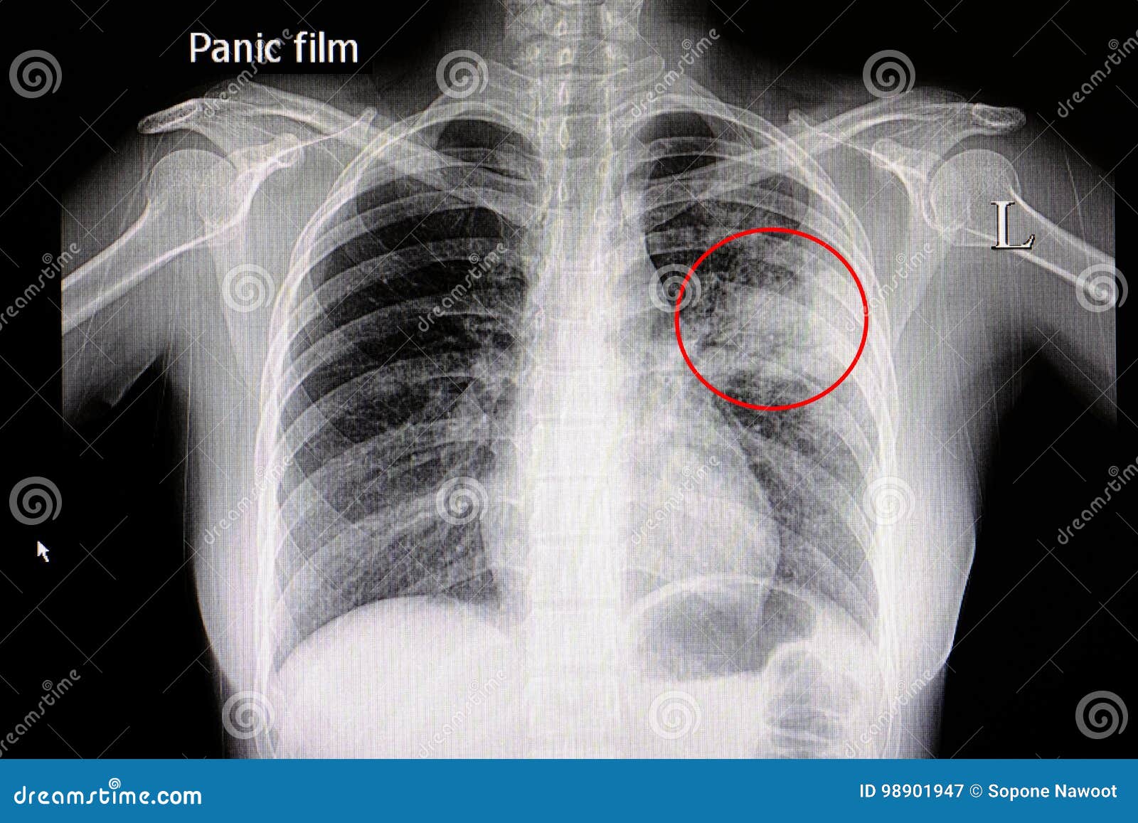 Polmonite immagine stock. Immagine di raggio, radiologia - 98901947