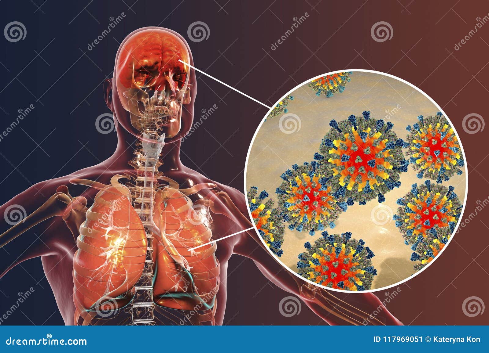 Polmonite Ed Encefalite Indotte Morbillo Illustrazione di Stock ...