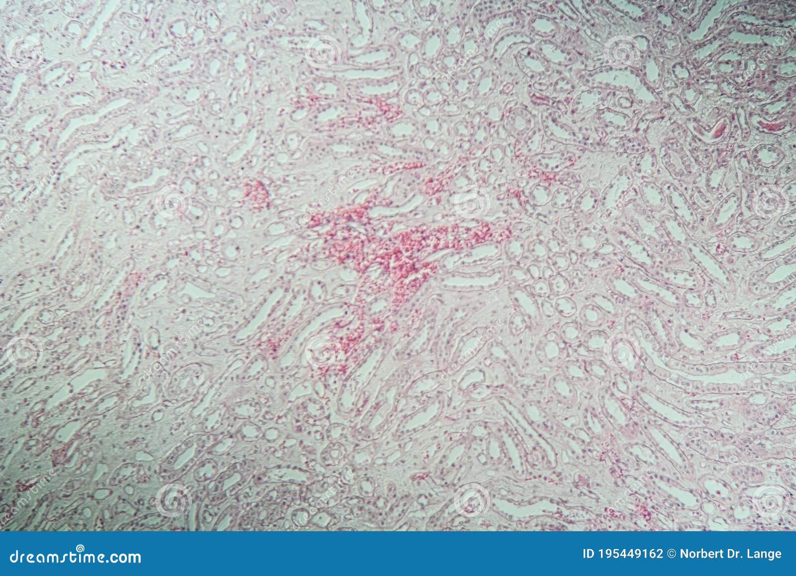 Poly nephritis, tissue stock photo. Image of pathology - 195449162
