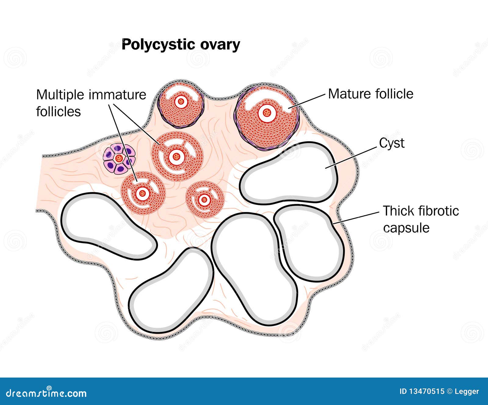 Polycystic eierstok vector illustratie. Illustration of secundair ...