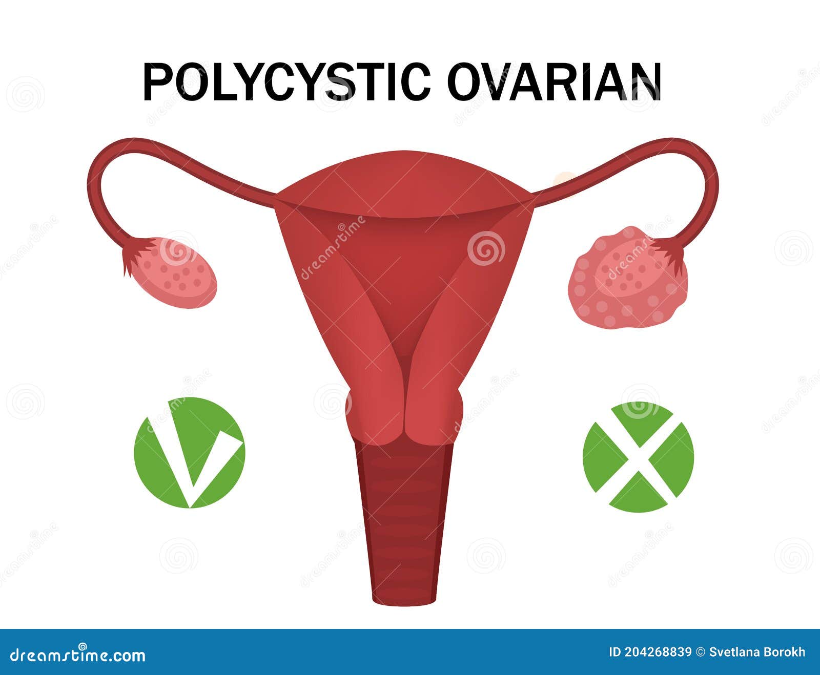 Polycystic Ovary Disease And A Healthy Ovary Medical Infographics