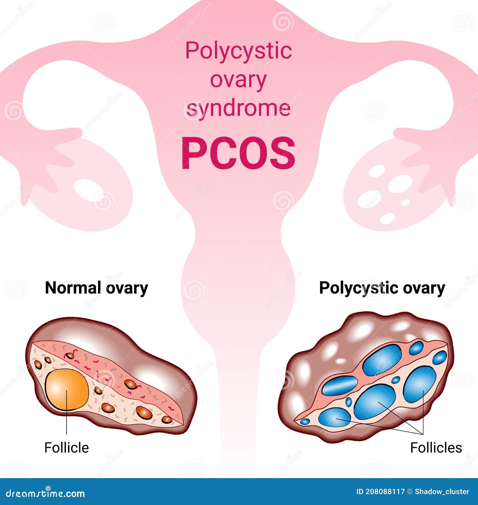 Polycystic Ovary Syndrome Pcos Hormonal Diagnose Medical Illustration