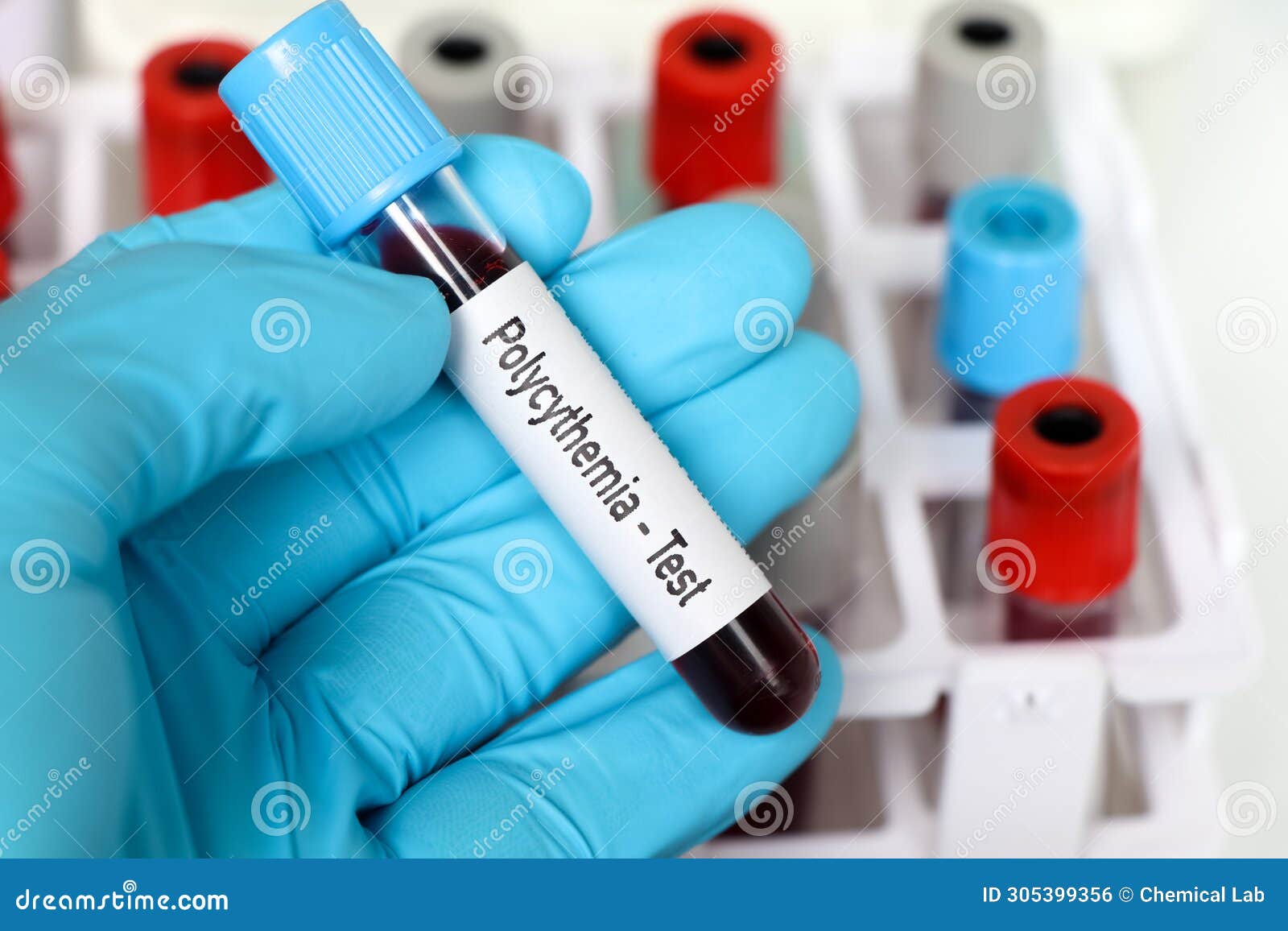 Polycythemia Test, Blood Sample To Analyze in the Laboratory Stock ...