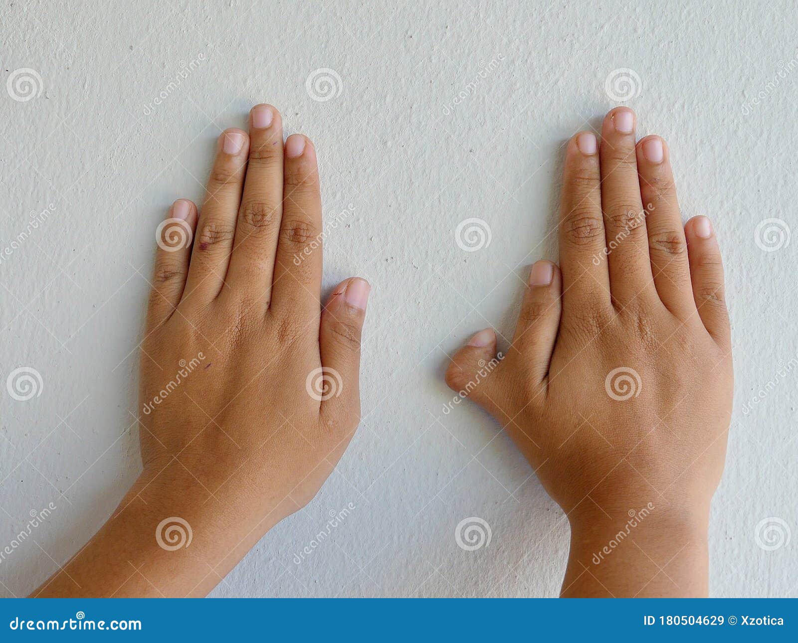 Polydactyly on Human; Rare Abnormal Characteristic Causes by Chromosome ...