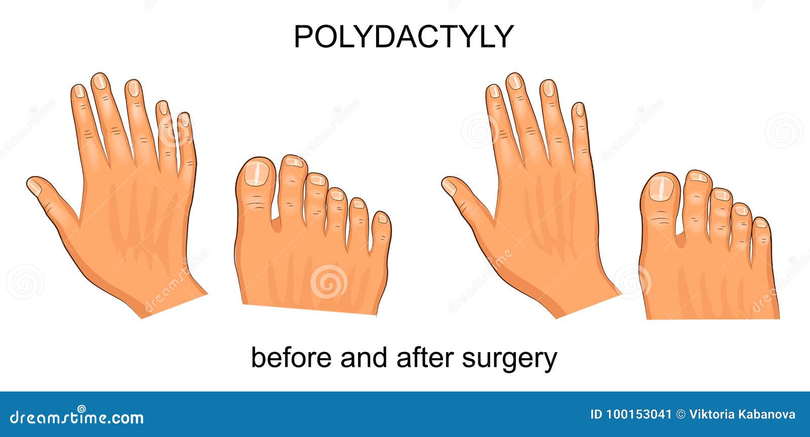 Polydactyly Cartoons, Illustrations & Vector Stock Images - 11 Pictures ...