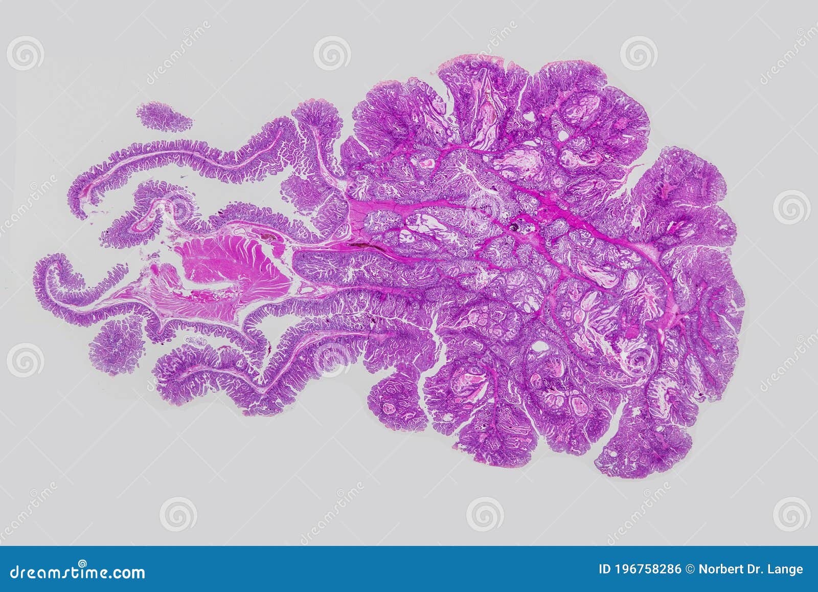 Colon polyp stock photo. Image of polyp, benign, histology - 196758286