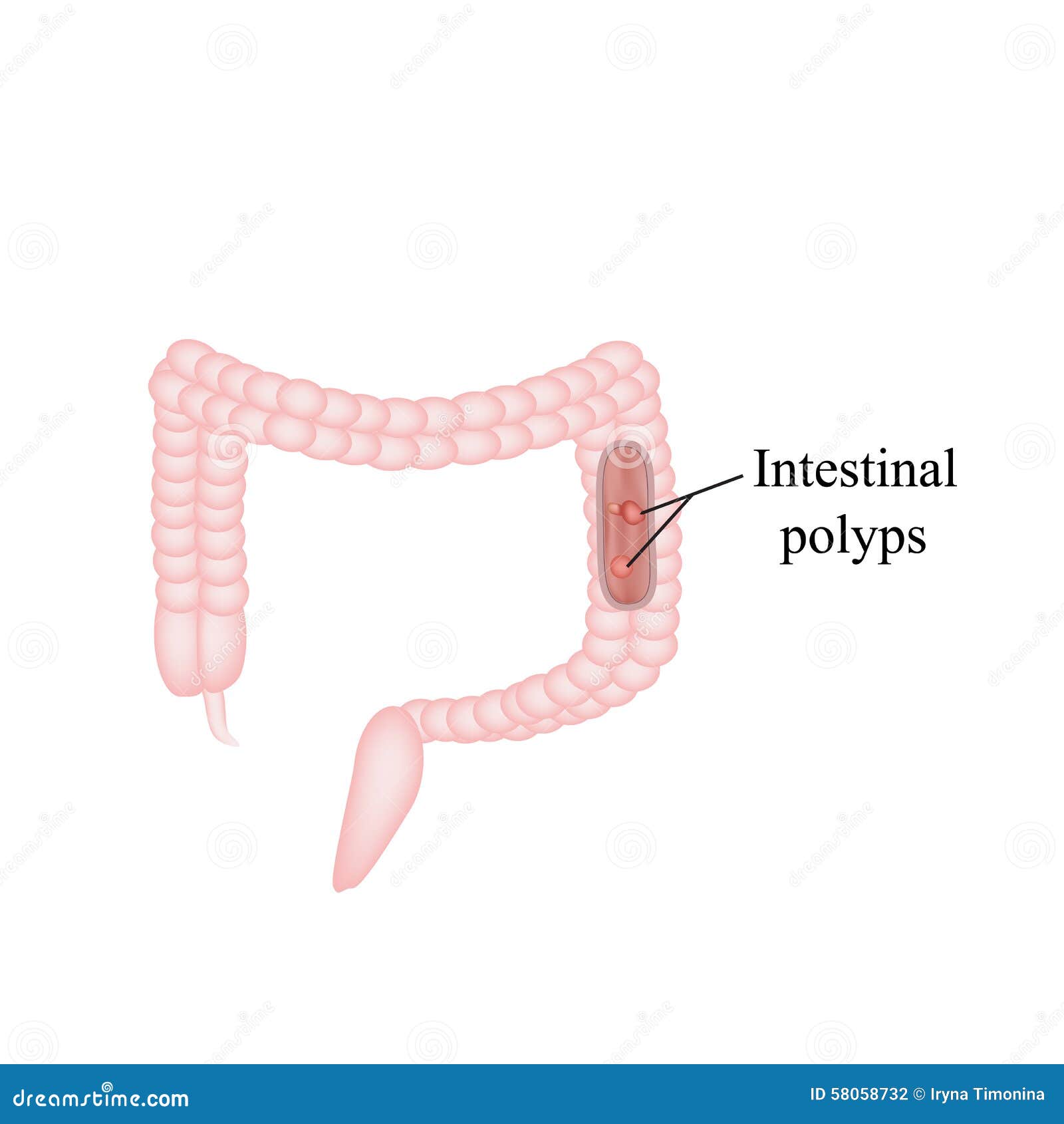 Diverticulitis Vector Illustration. Labeled Diagram With Its Structure ...