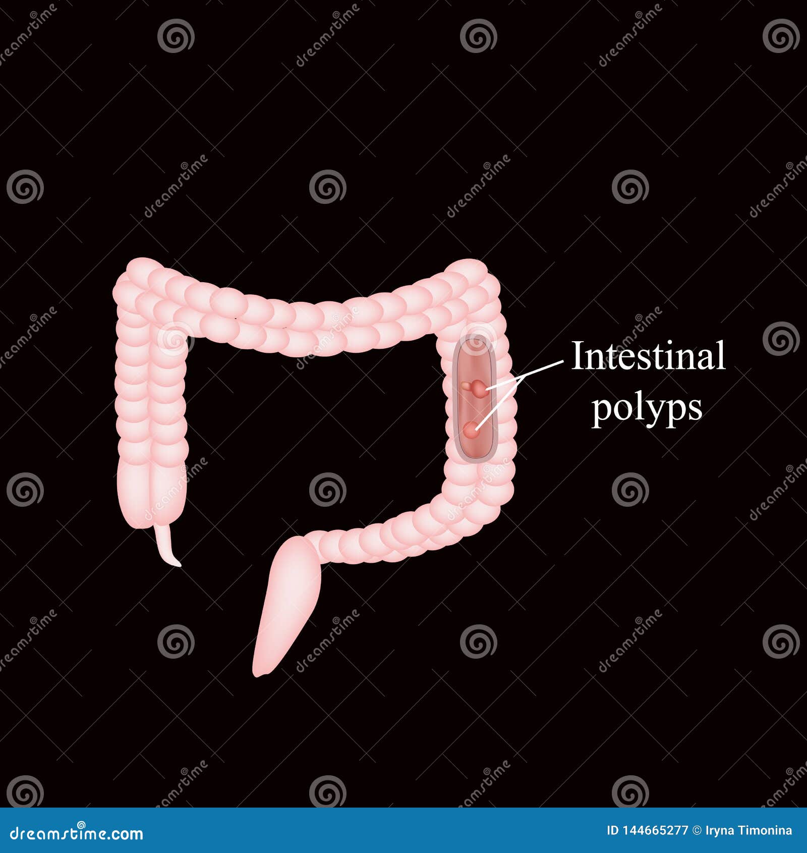 Diverticulitis Vector Illustration. Labeled Diagram With Its Structure ...