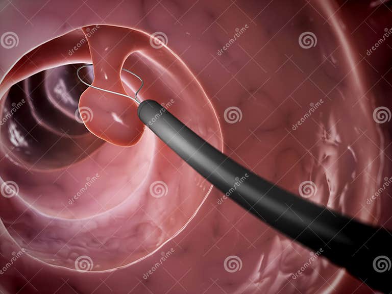 Polyp removal stock illustration. Illustration of surgery - 30724657