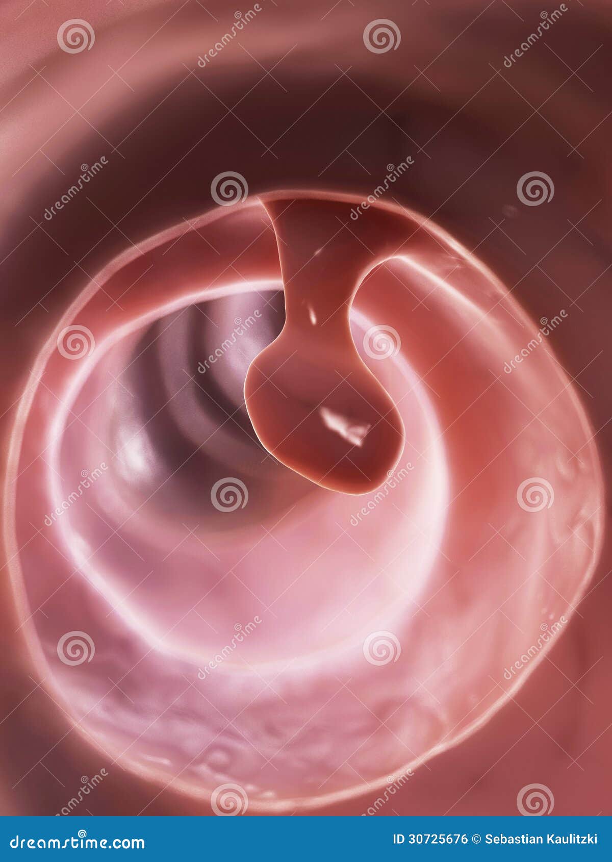 Polype de deux points illustration stock. Illustration du rectum - 30725676