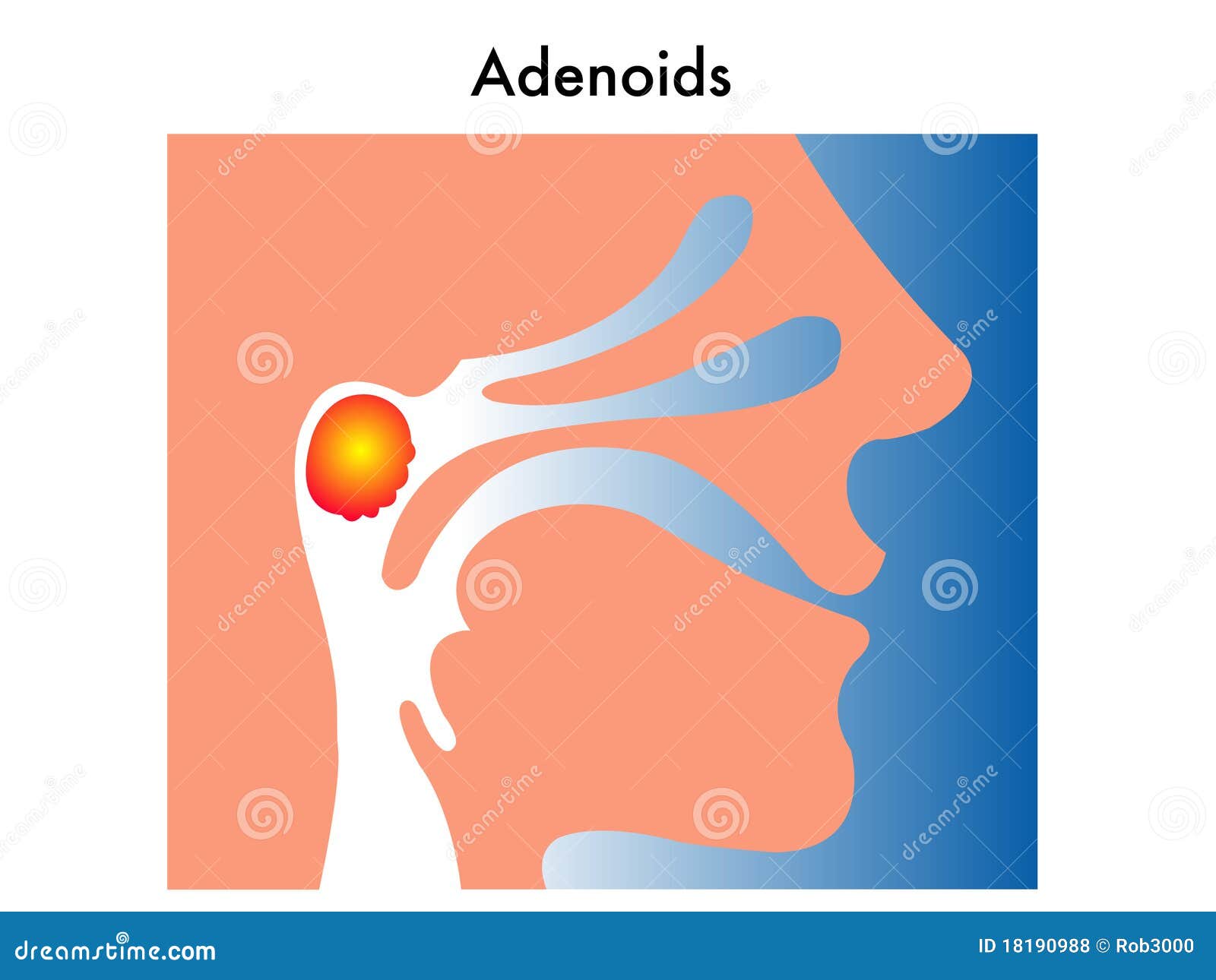 Polyper vektor illustrationer. Illustration av smärta - 18190988
