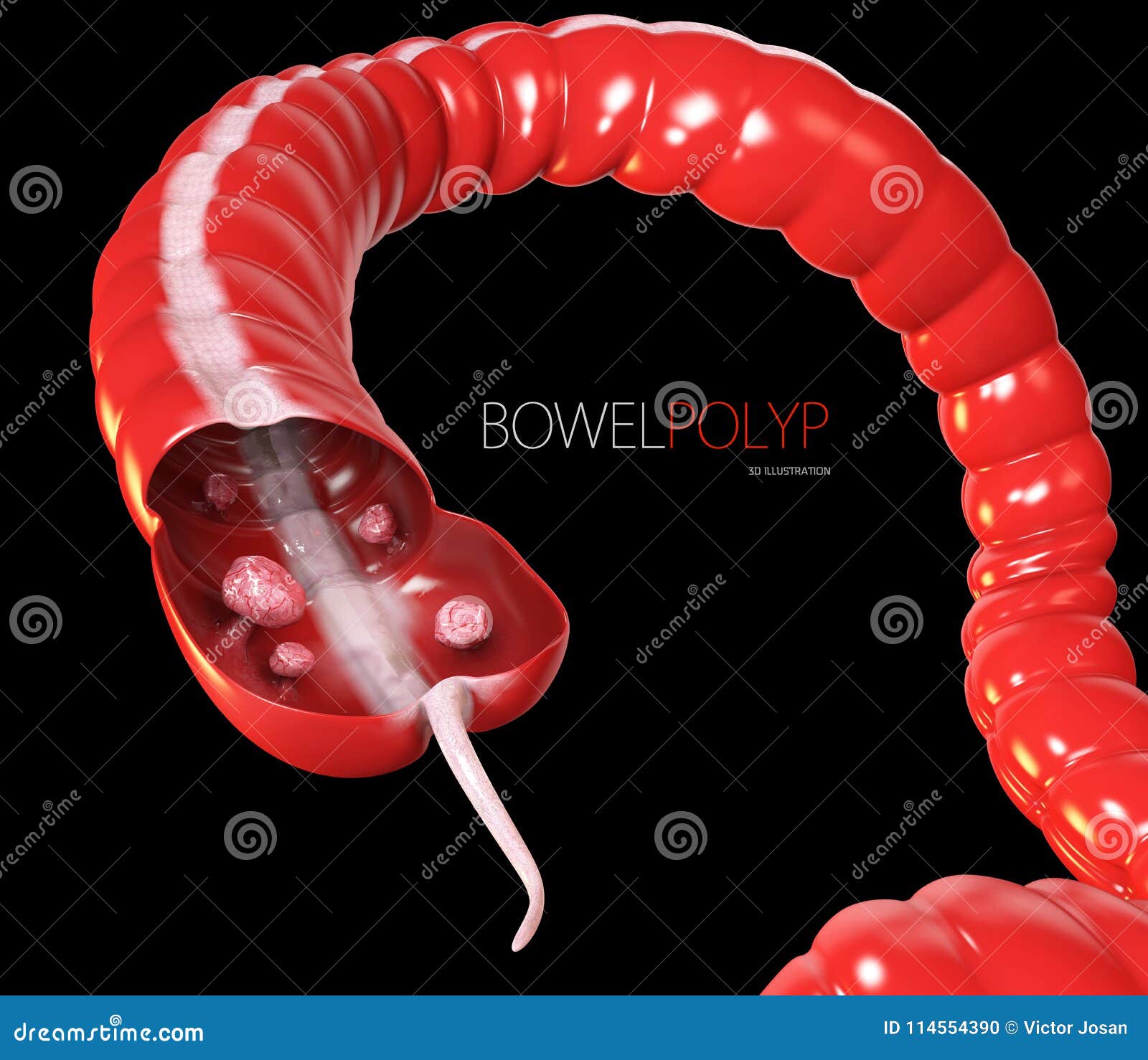 Polypes De Deux Points Polype De L'illustration 3d Dans L'intestin Noir ...