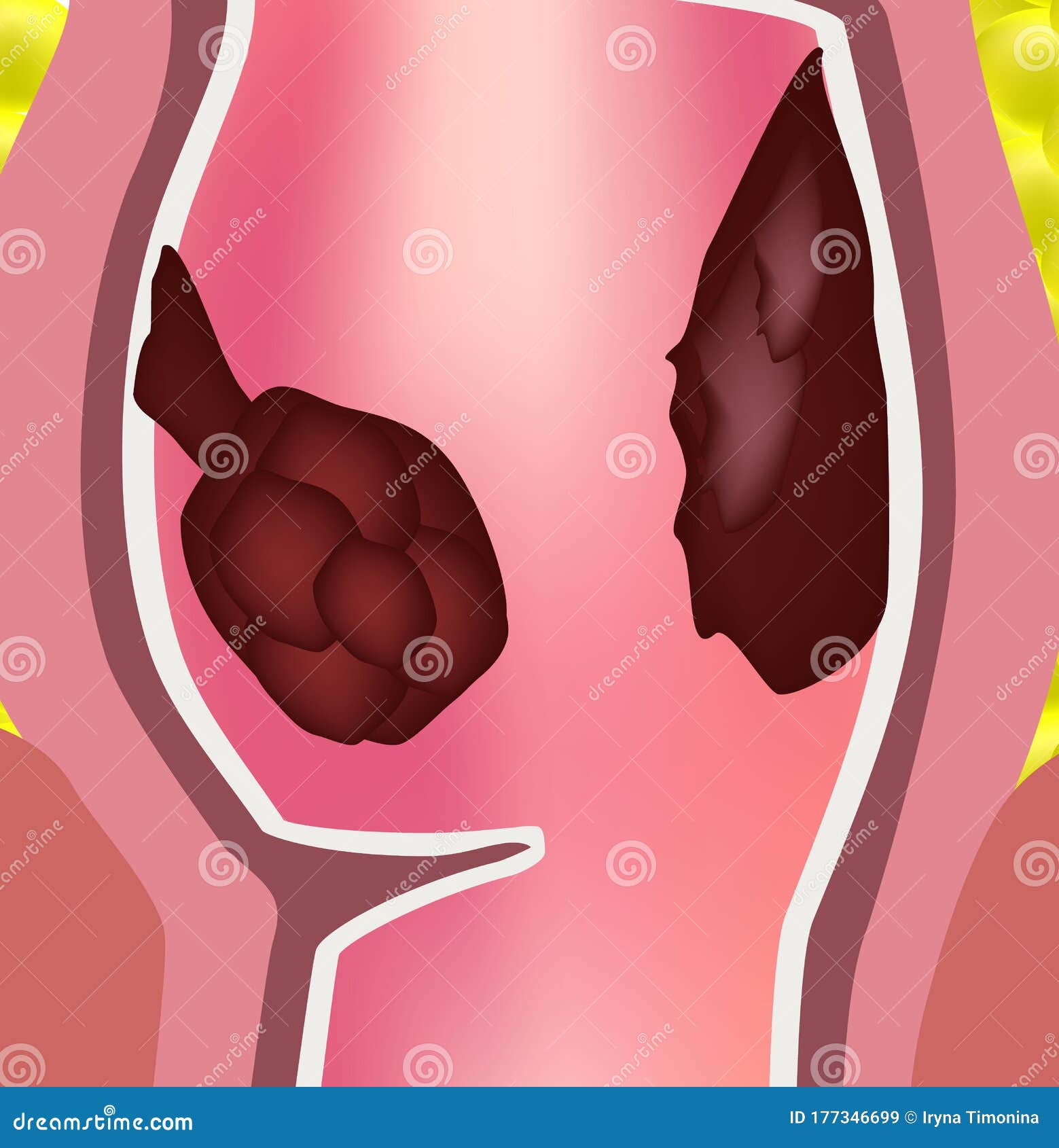 Polyps in the Rectum. the Structure of the Rectum of the Intestine ...