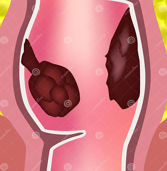 Polyps in the Rectum. the Structure of the Rectum of the Intestine ...