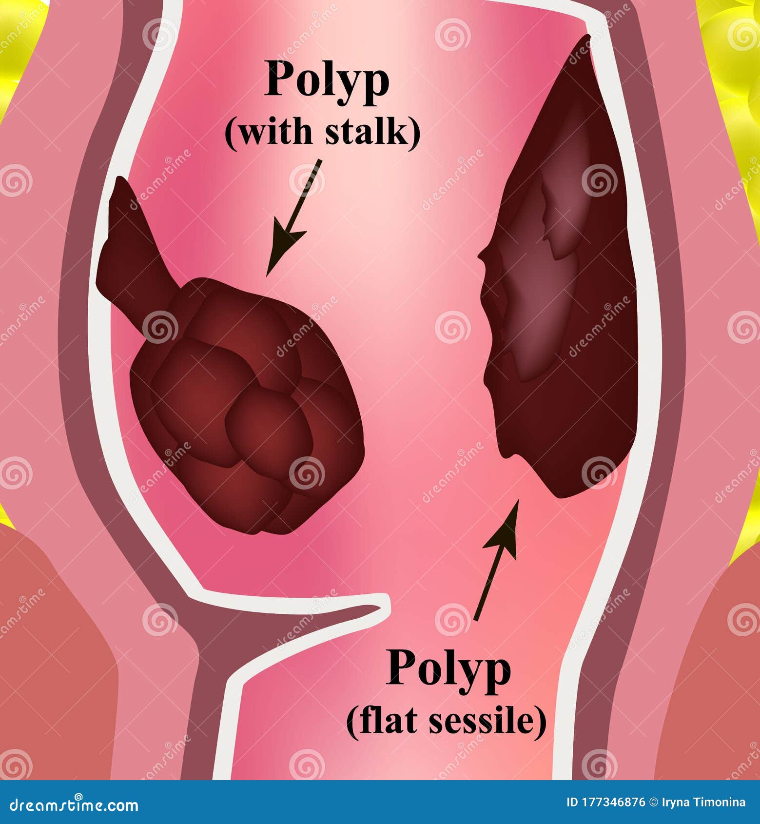 Polyps in the Rectum. the Structure of the Rectum of the Intestine ...