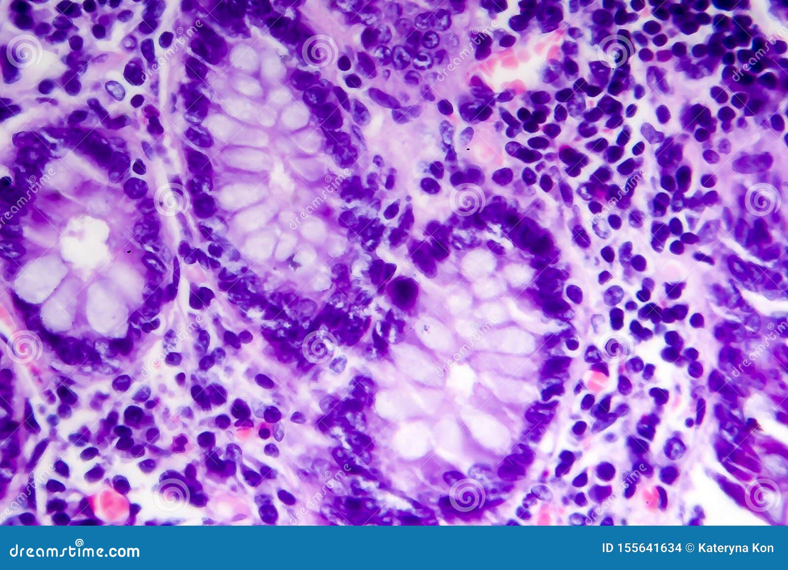 Differentiated Intestinal Adenocarcinoma, Light Micrograph Royalty-Free ...