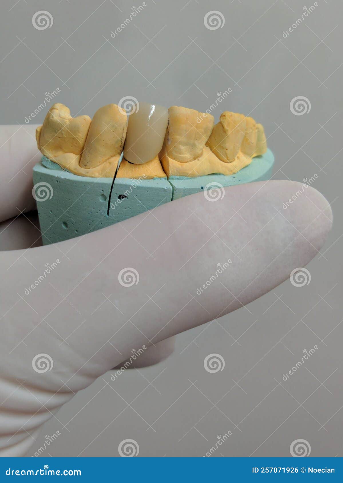 Porcelain crown on metal stock photo. Image of metal - 257071926