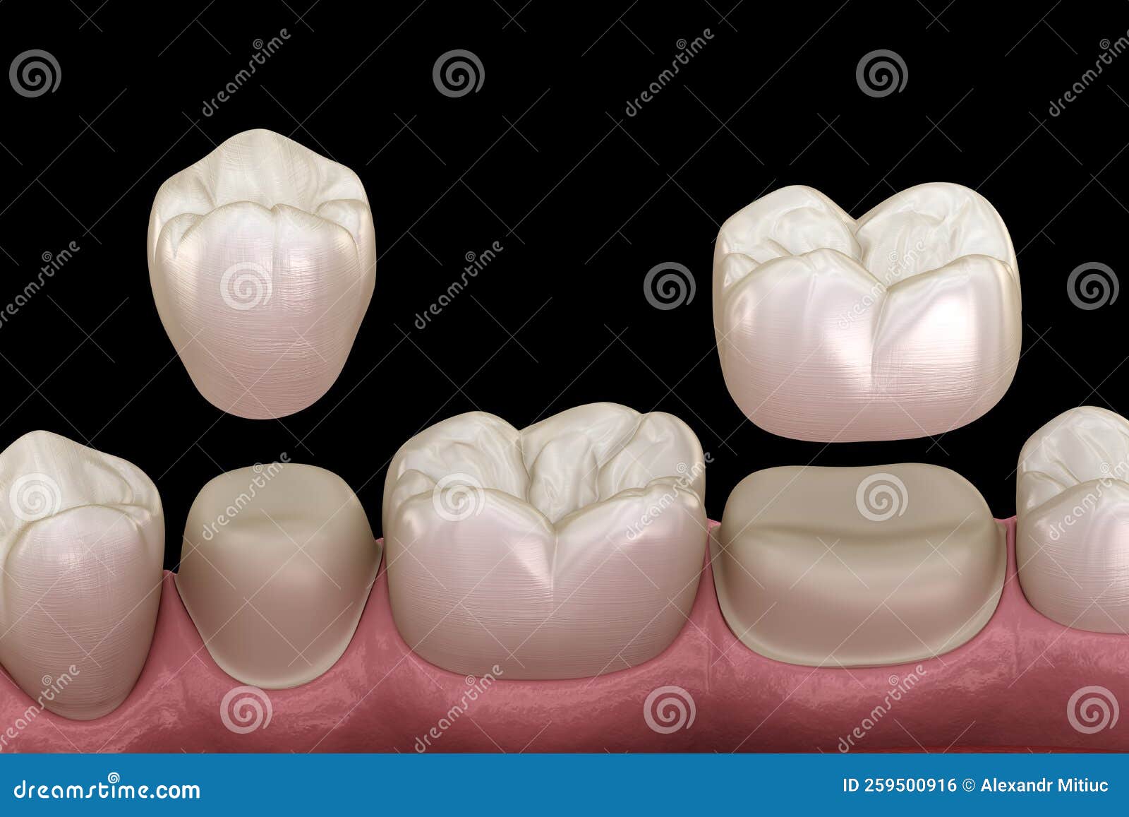 Porcelain Crowns Placement Over Premolar and Molar Teeth. . Medically ...