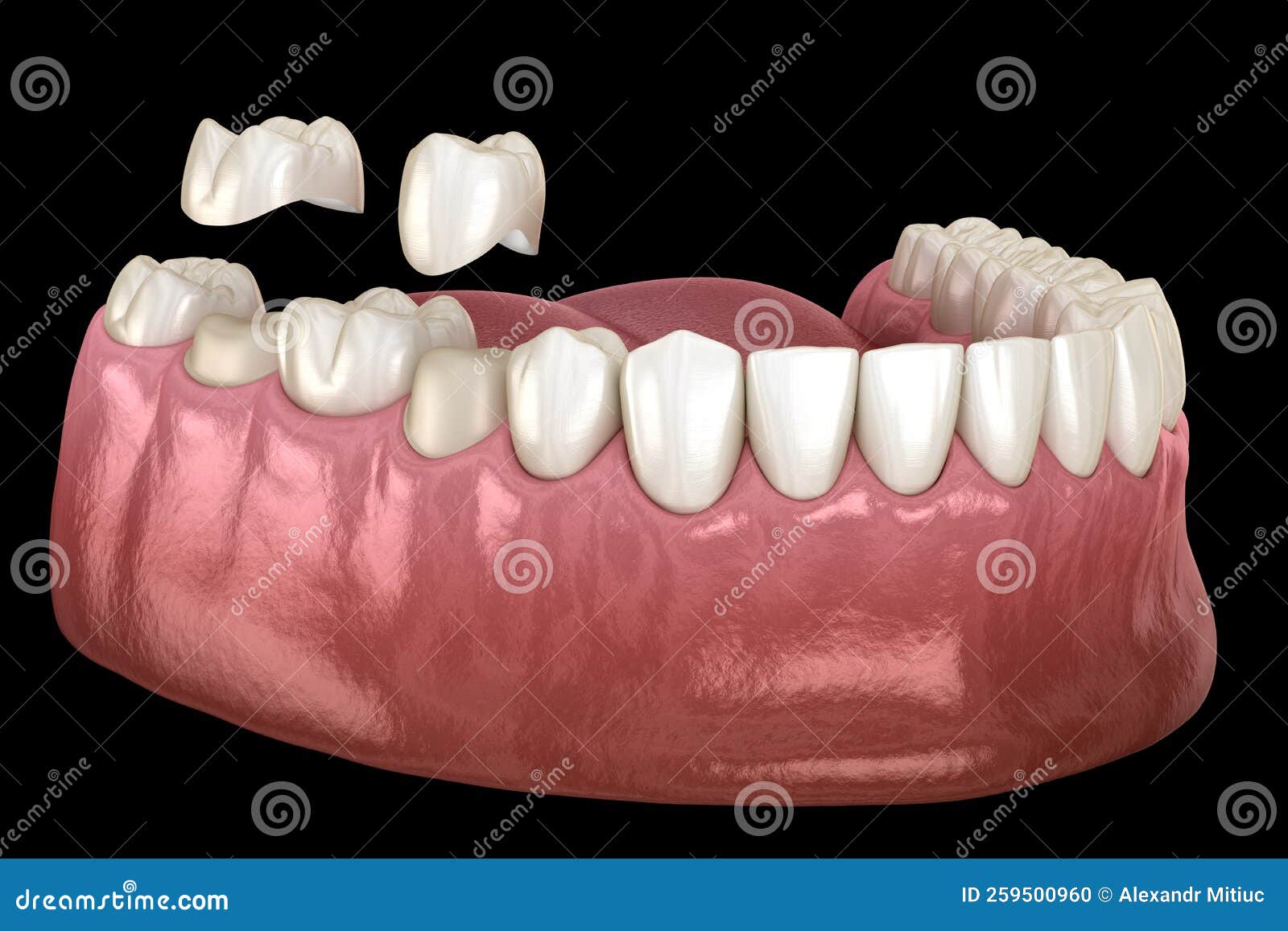 Porcelain Crowns Placement Over Premolar and Molar Teeth. . Medically ...