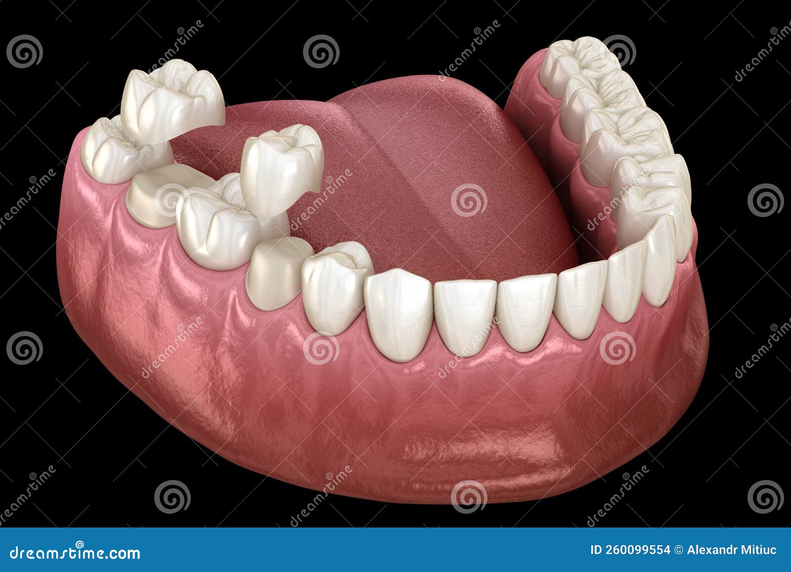 Porcelain Crowns Placement Over Premolar and Molar Teeth. Medically ...