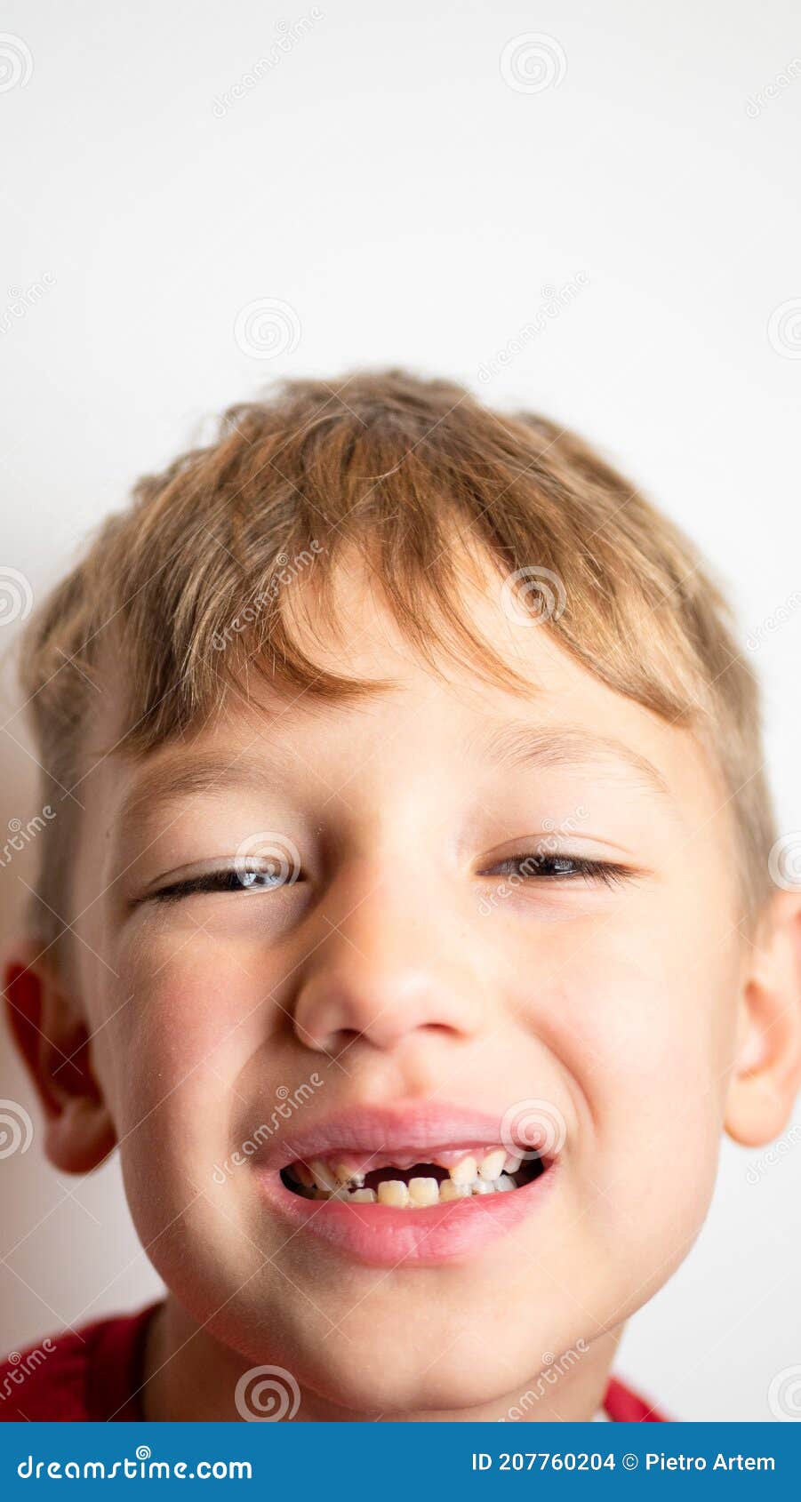 Portrait of a Boy with Bad Teeth, Fallen Front Upper Teeth Stock Photo ...