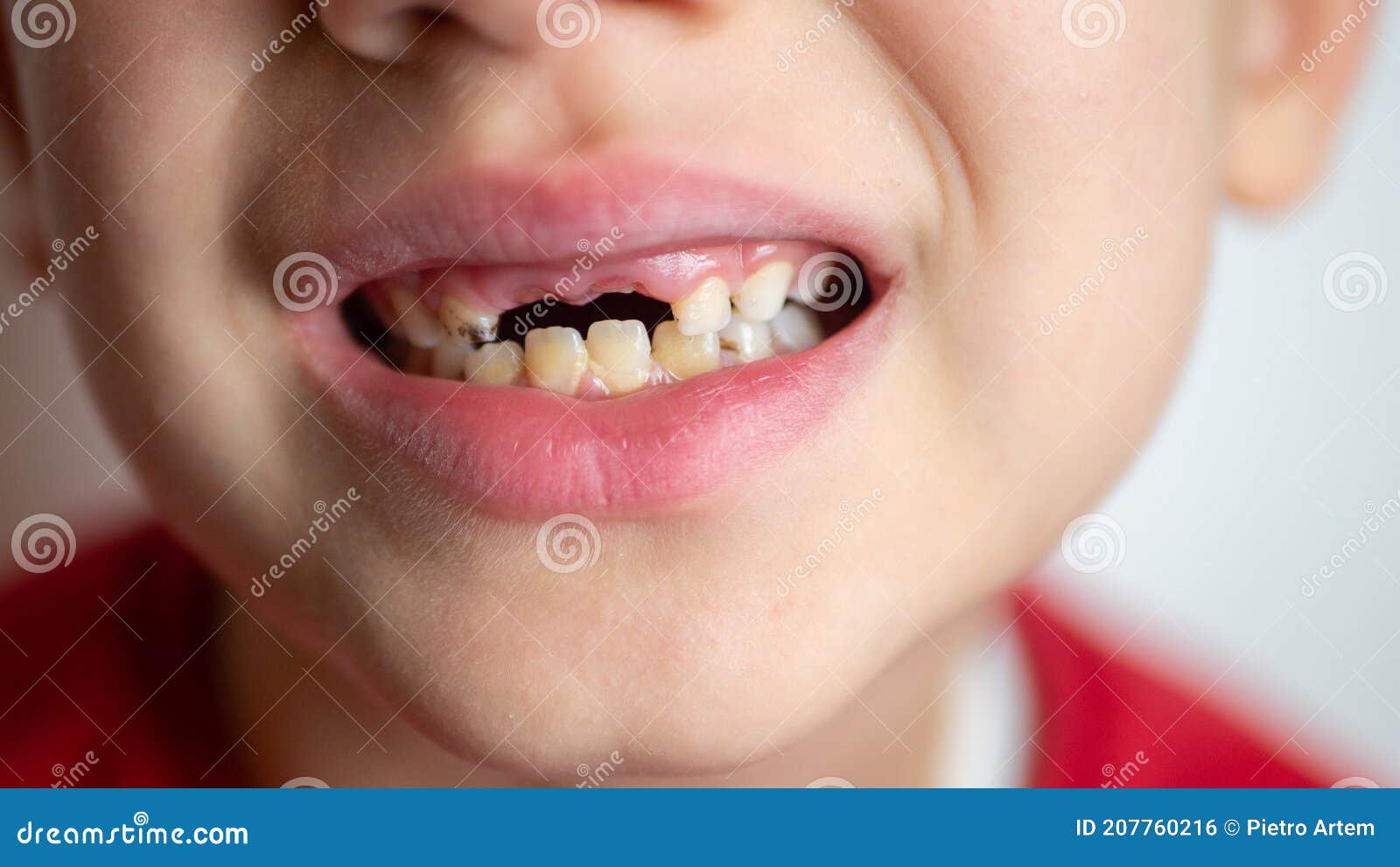 Portrait of a Boy with Bad Teeth, Fallen Front Upper Teeth Stock Photo ...