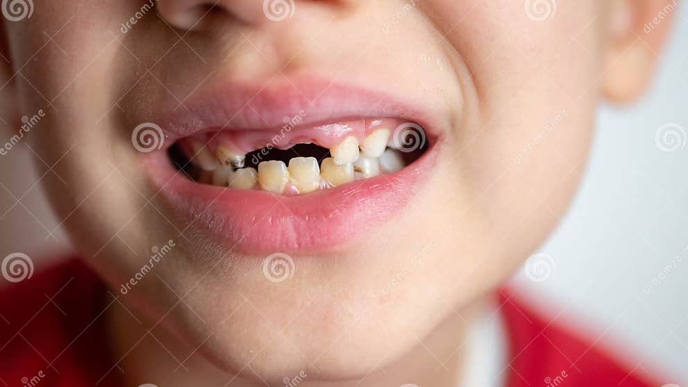 Portrait of a Boy with Bad Teeth, Fallen Front Upper Teeth Stock Photo ...