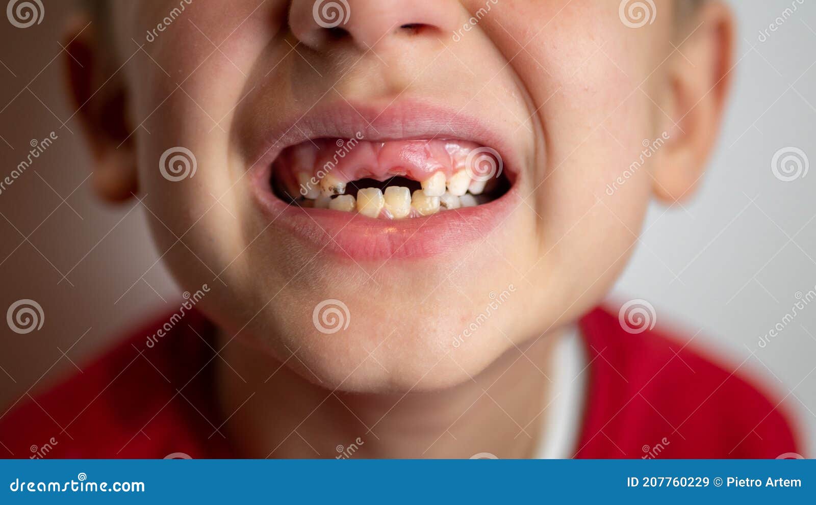 Portrait of a Boy with Bad Teeth, Fallen Front Upper Teeth Stock Image ...