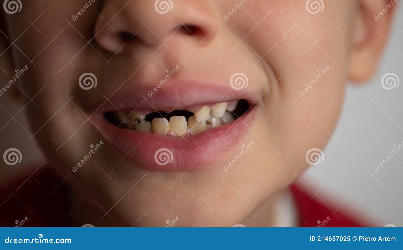 Portrait of a Boy with Bad Teeth, Fallen Front Upper Teeth Stock Image ...