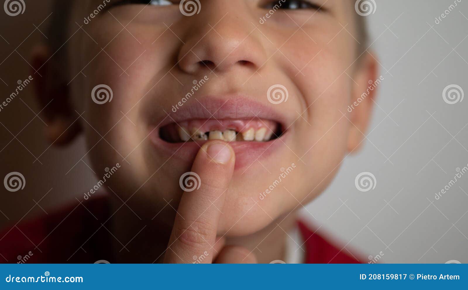 Portrait of a Boy with Bad Teeth, Fallen Front Upper Teeth Stock Image ...