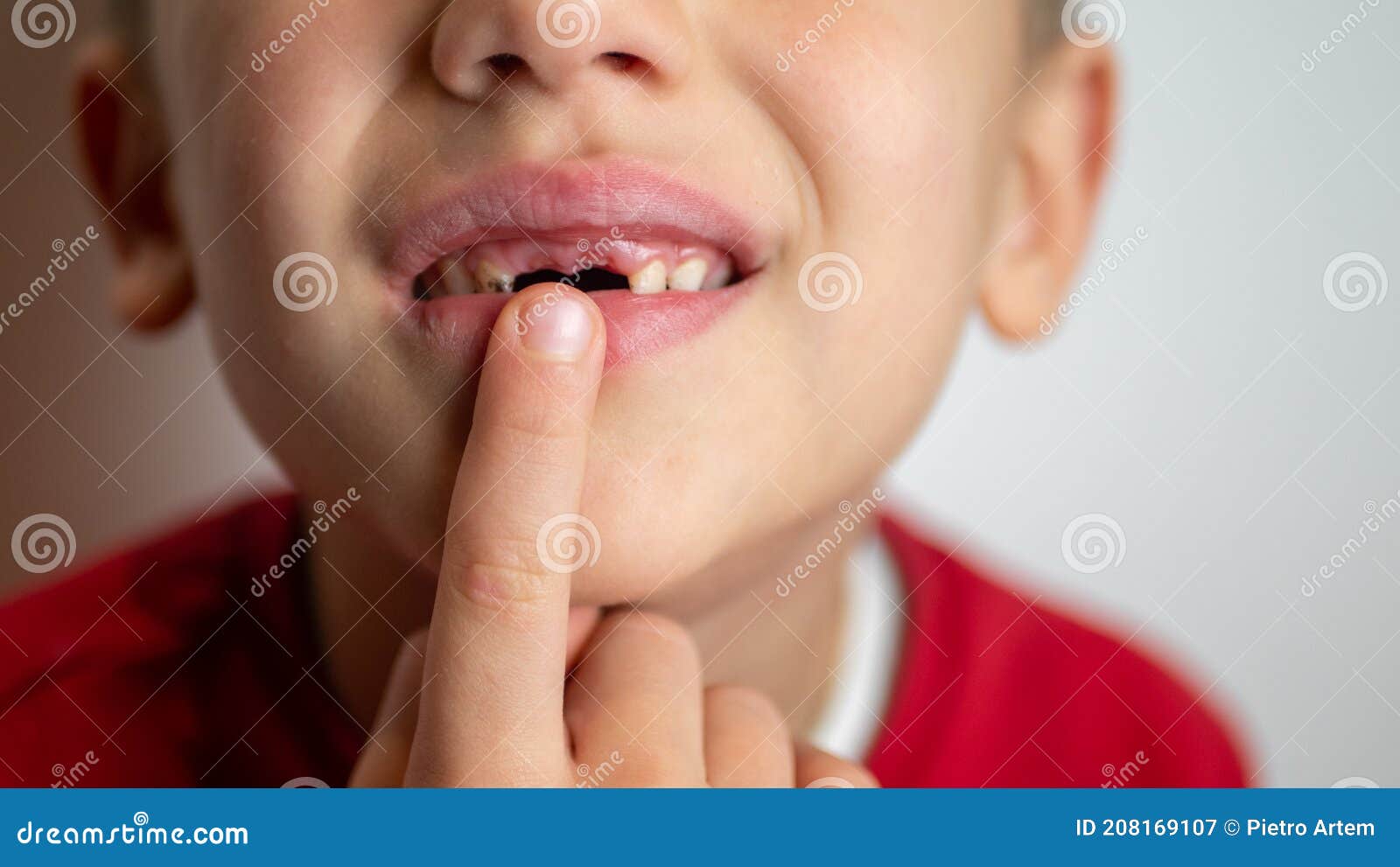 Portrait of a Boy with Bad Teeth, Fallen Front Upper Teeth Stock Image ...