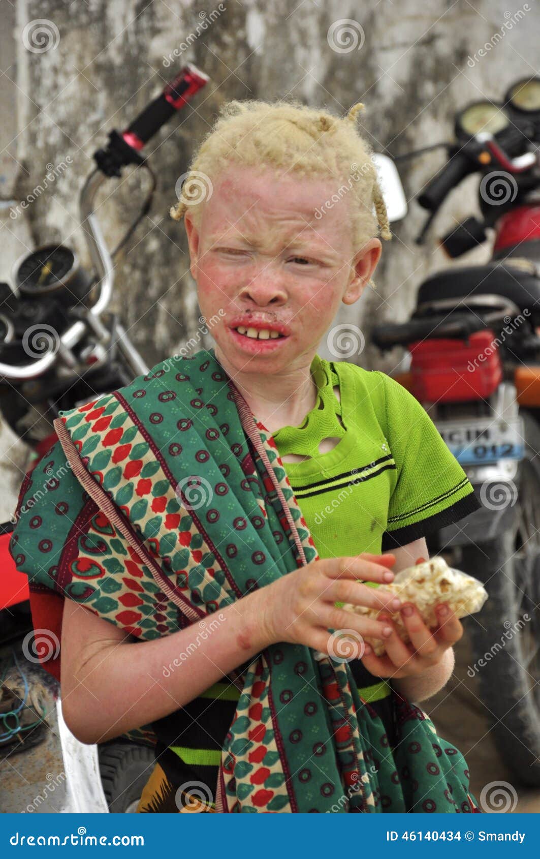 Portrait D'enfants Albinos De L'Afrique Image stock éditorial - Image ...