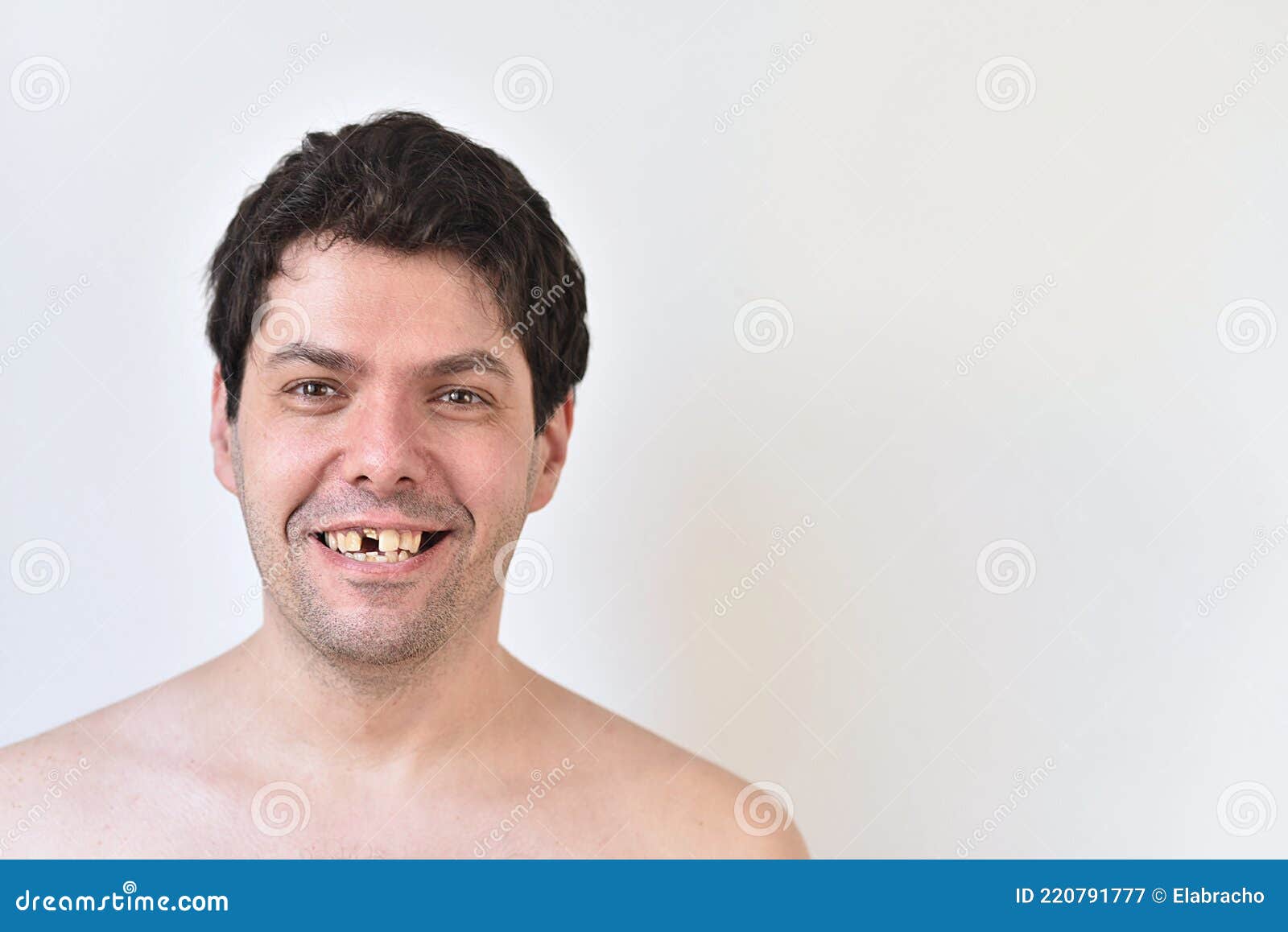 Portrait of a Man with Broken Teeth Stock Image - Image of caries ...