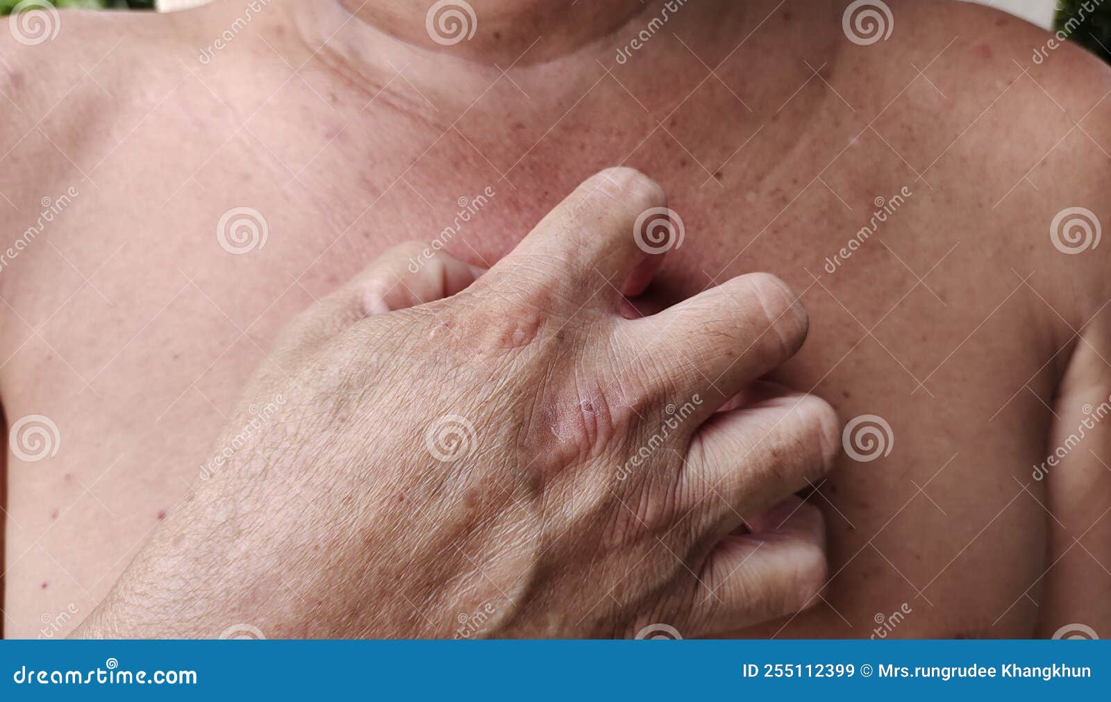 Skin Scratch Allergy Diseases Problem Close Up Of Atopic Dermatitis