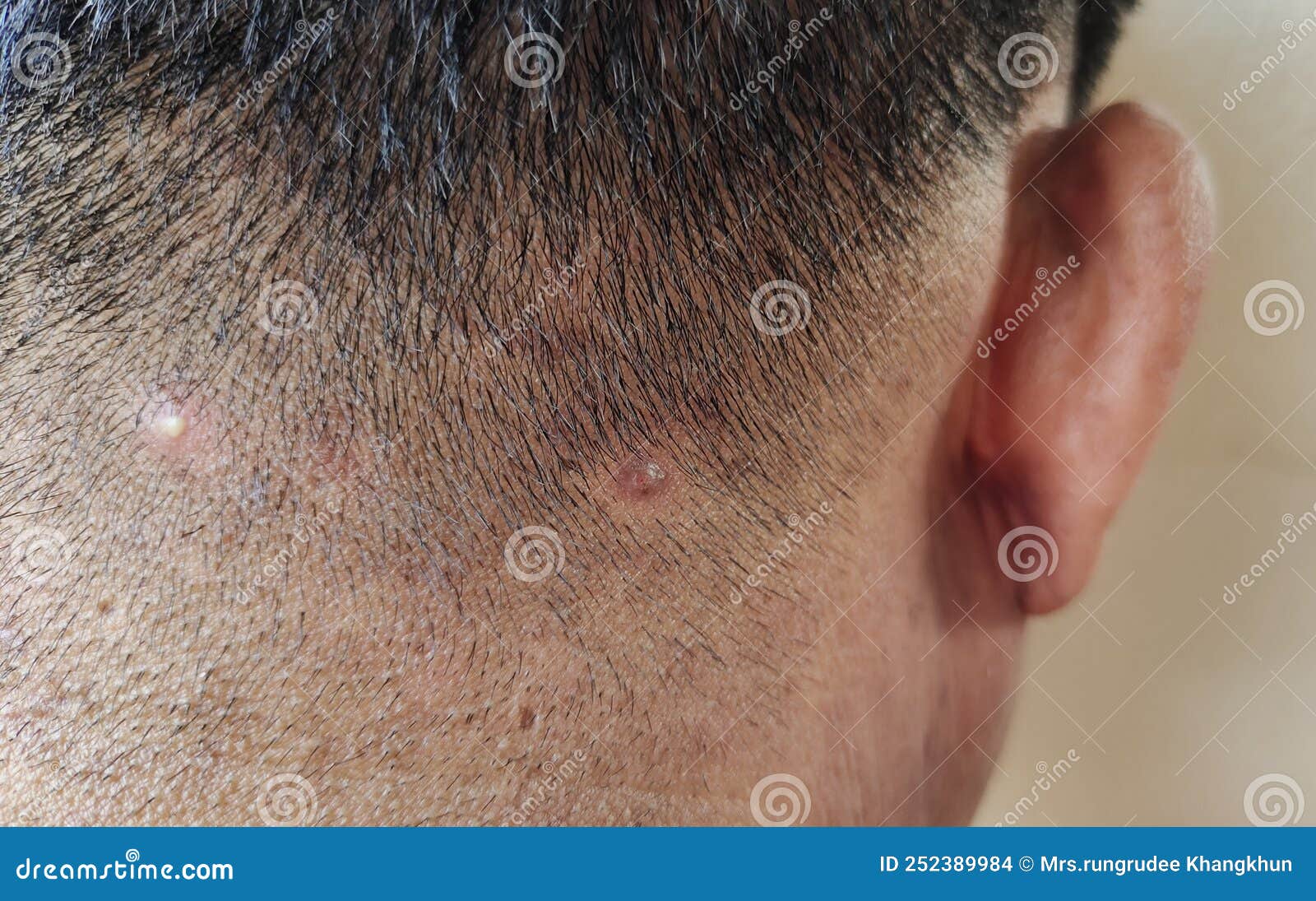 Pustule Acne Close Up Pimple On Female Skin Dermatology Puberty Woman Skin Reaction From