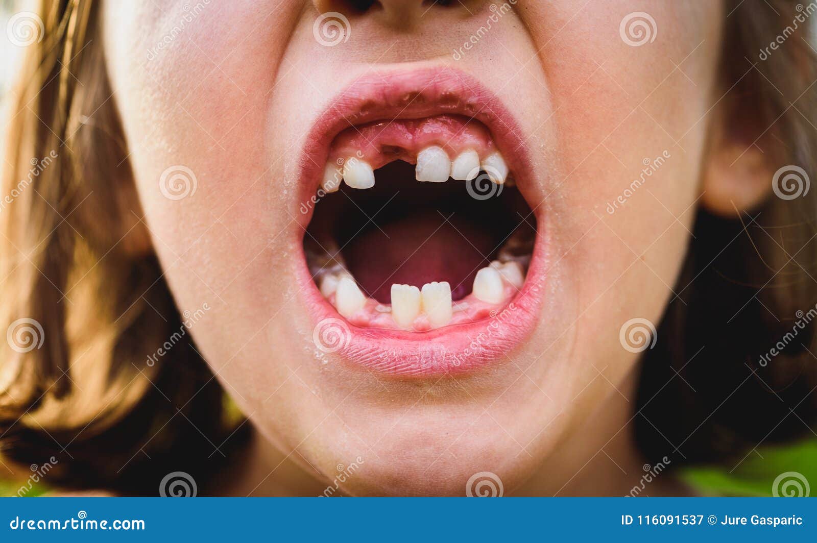 Portrait of Toothless Child Girl Missing Milk and Permanent Teeth ... Portrait of Toothless Child Girl Missing Milk and Permanent Teeth ...