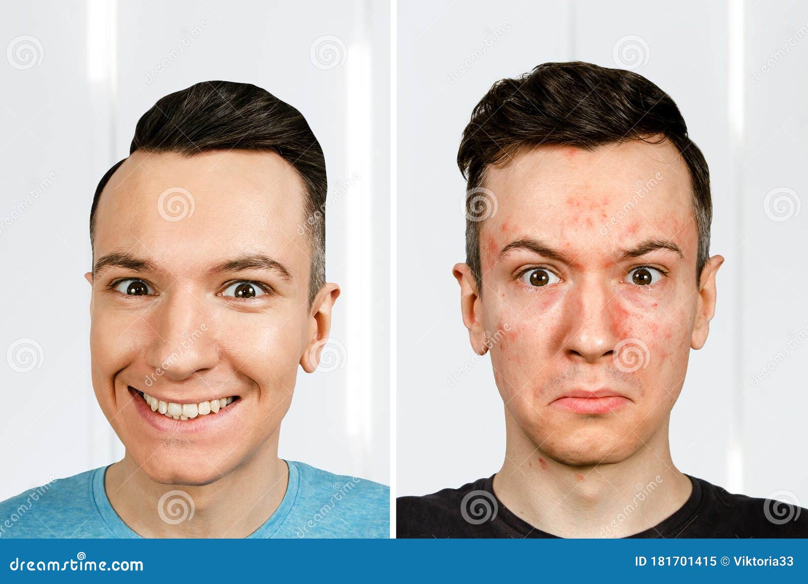 Portrait of Young Guy with Allergy, with Red Face. Man before - after ...