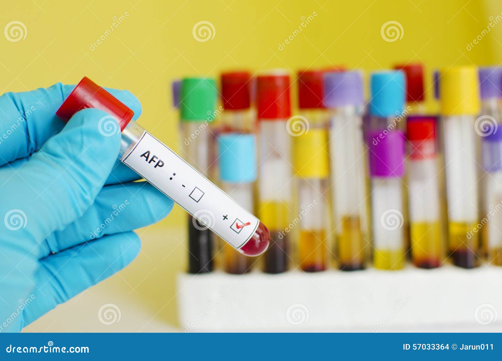 Alfafetoproteína Alta Falso Positivo - RETOEDU