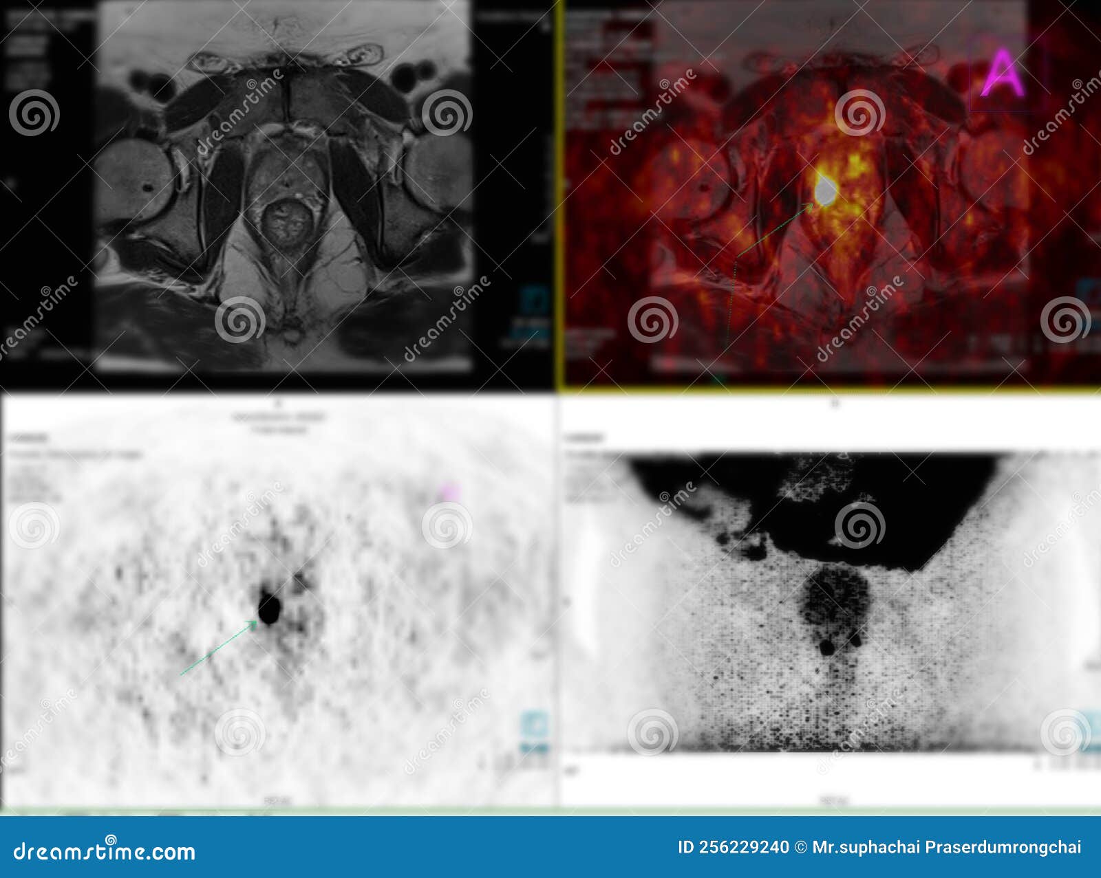 Positron Emission Tomography Scan Positron Emission Tomography Scan