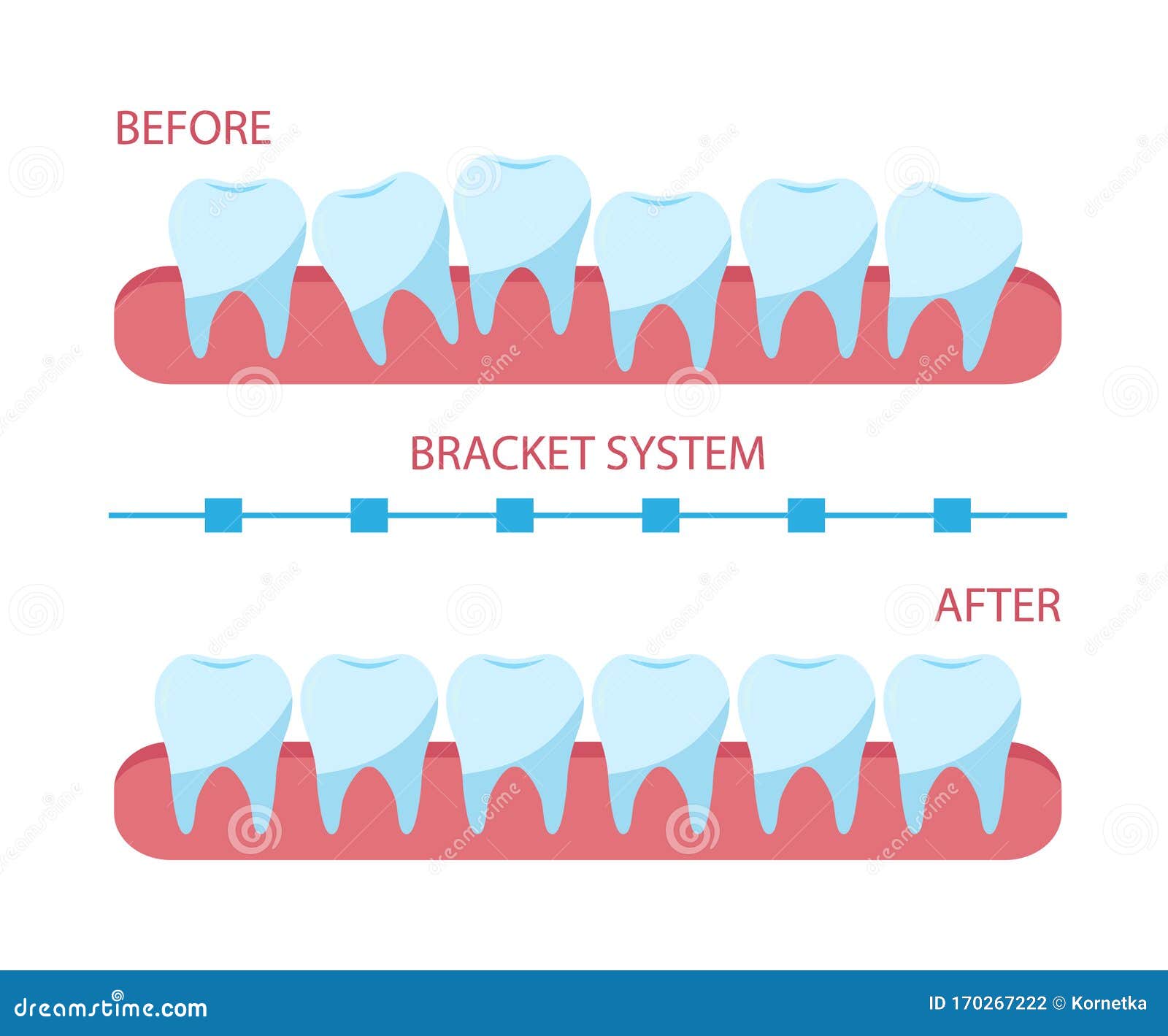 Poster Bracket System, Flat Style. Process of Correction of Teeth with ...