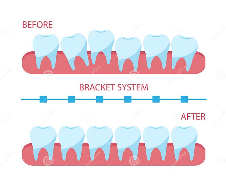 Poster Bracket System, Flat Style. Process of Correction of Teeth with ...