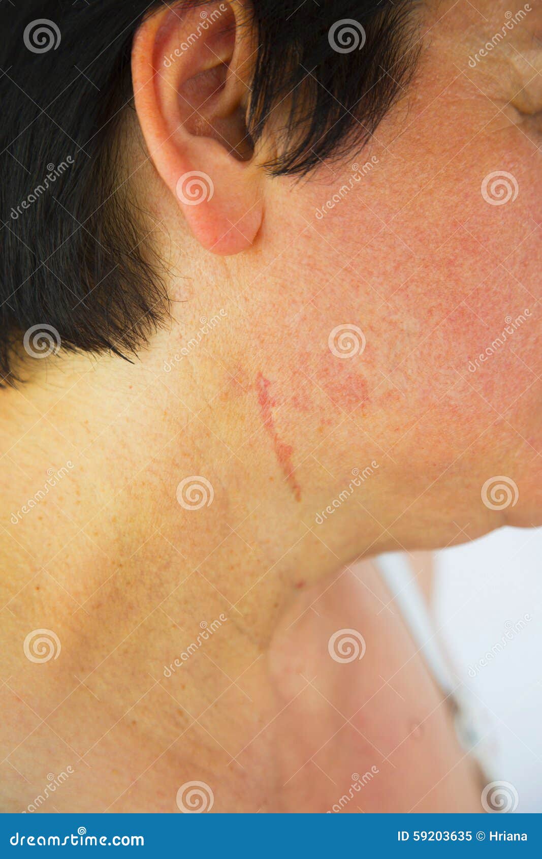 Postoperatief Litteken Van De Chirurgie Van De Halsslagader Stock ...