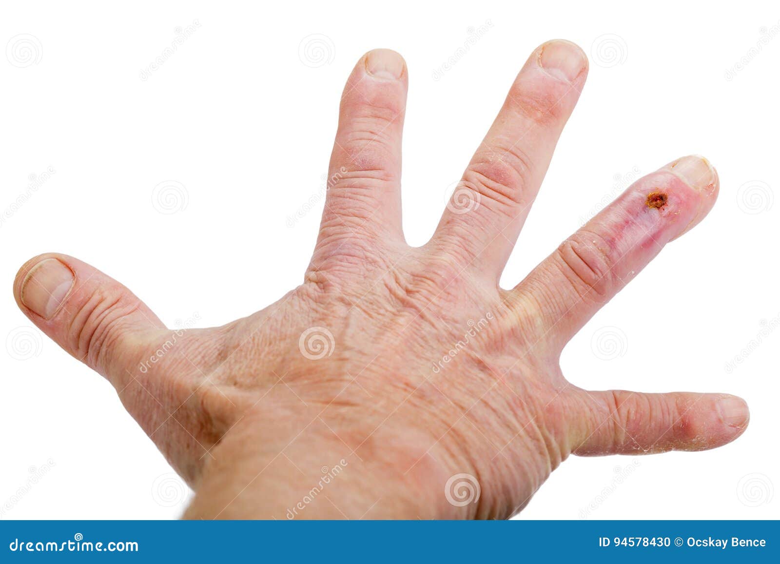 Postoperative Scar on the Fourth Finger Stock Photo - Image of entry ...
